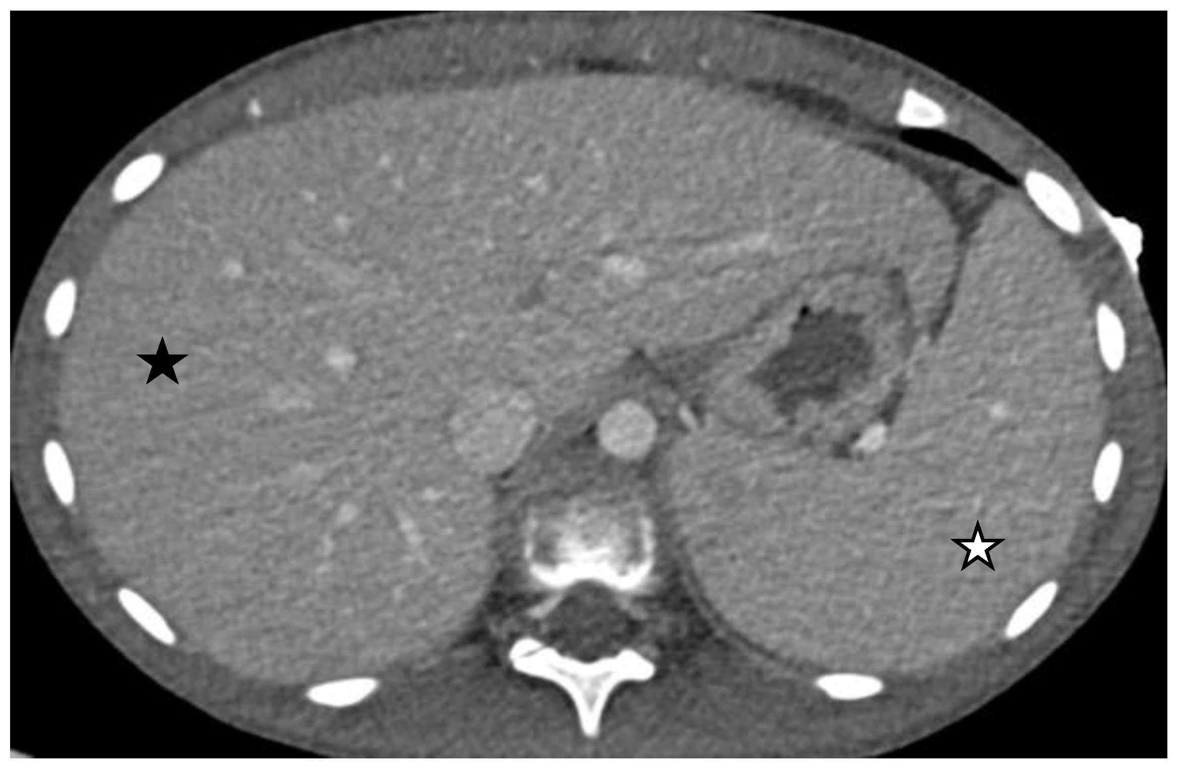 Abdominal and Thoracic Imaging Features in Children with MIS-C