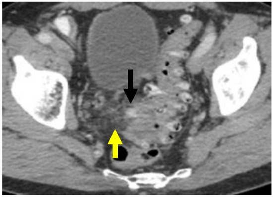 Diverticular Disease—An Updated Management Review