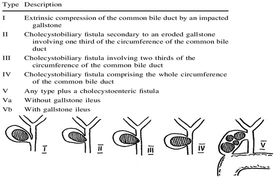 Gastroenterology Insights | Free Full-Text | Cholangioscopy-Assisted ...