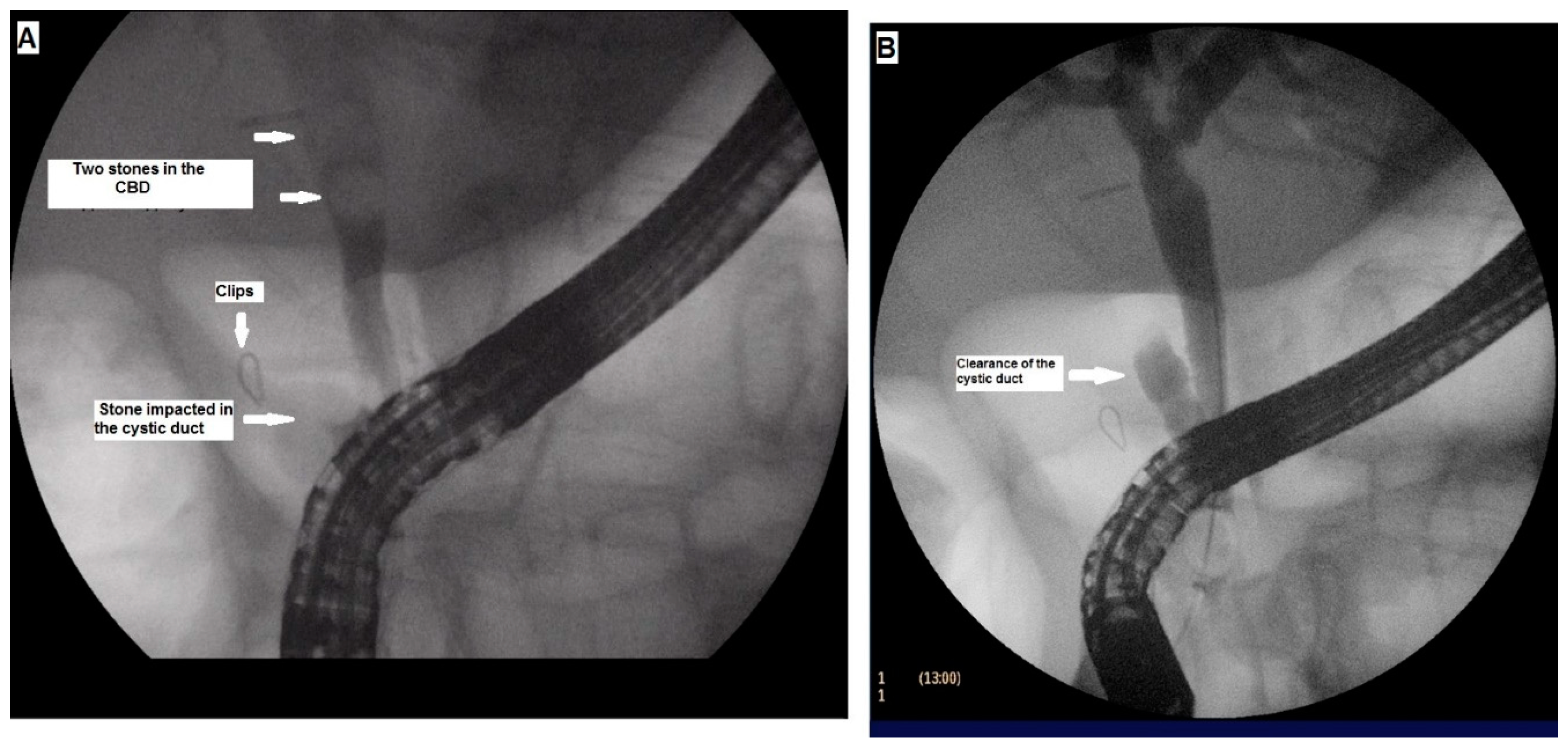 Gastroenterology Insights | Free Full-Text | Cholangioscopy-Assisted ...