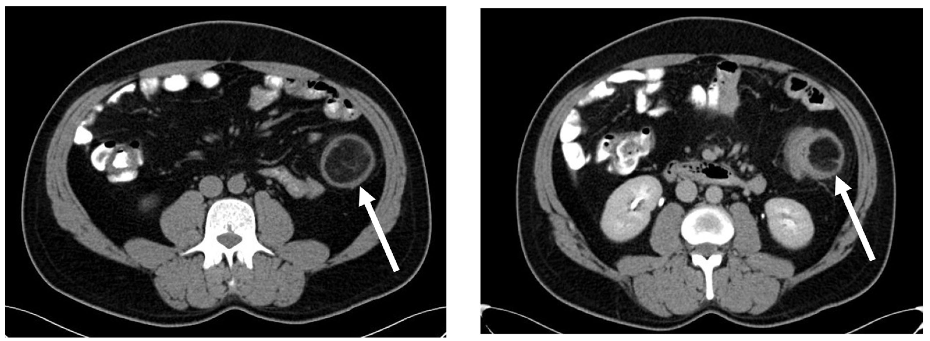 Abdominal Pain—Beyond Colonic Lipoma Intussusception