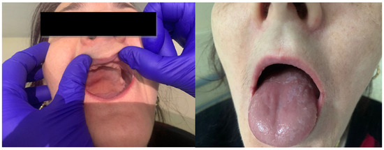 Celiac Disease Presented as Plummer–Vinson Syndrome: A Case Report