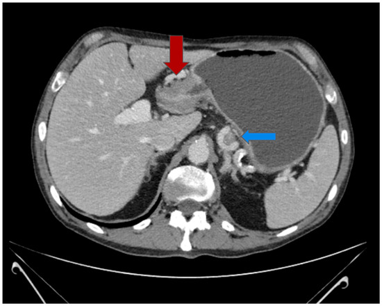 Hiccups as the First Symptom of a Complication of Total Gastrectomy for ...