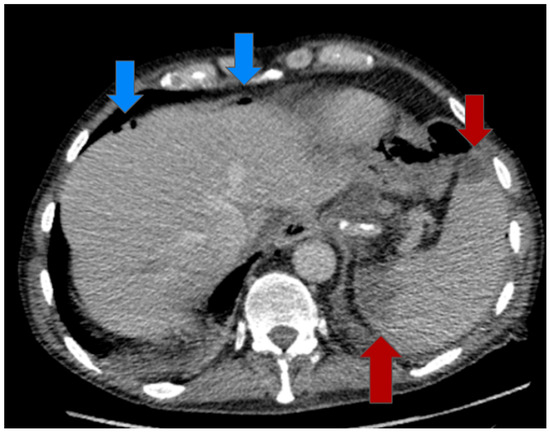 Hiccups as the First Symptom of a Complication of Total Gastrectomy for ...