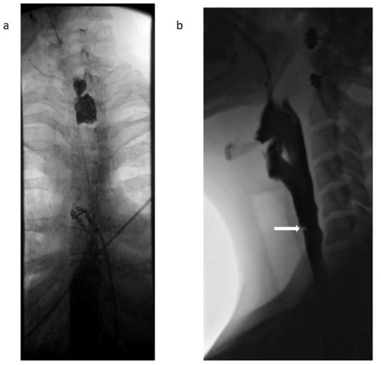 Plummer-Vinson Syndrome: A Time for Redefinition and New Perspectives