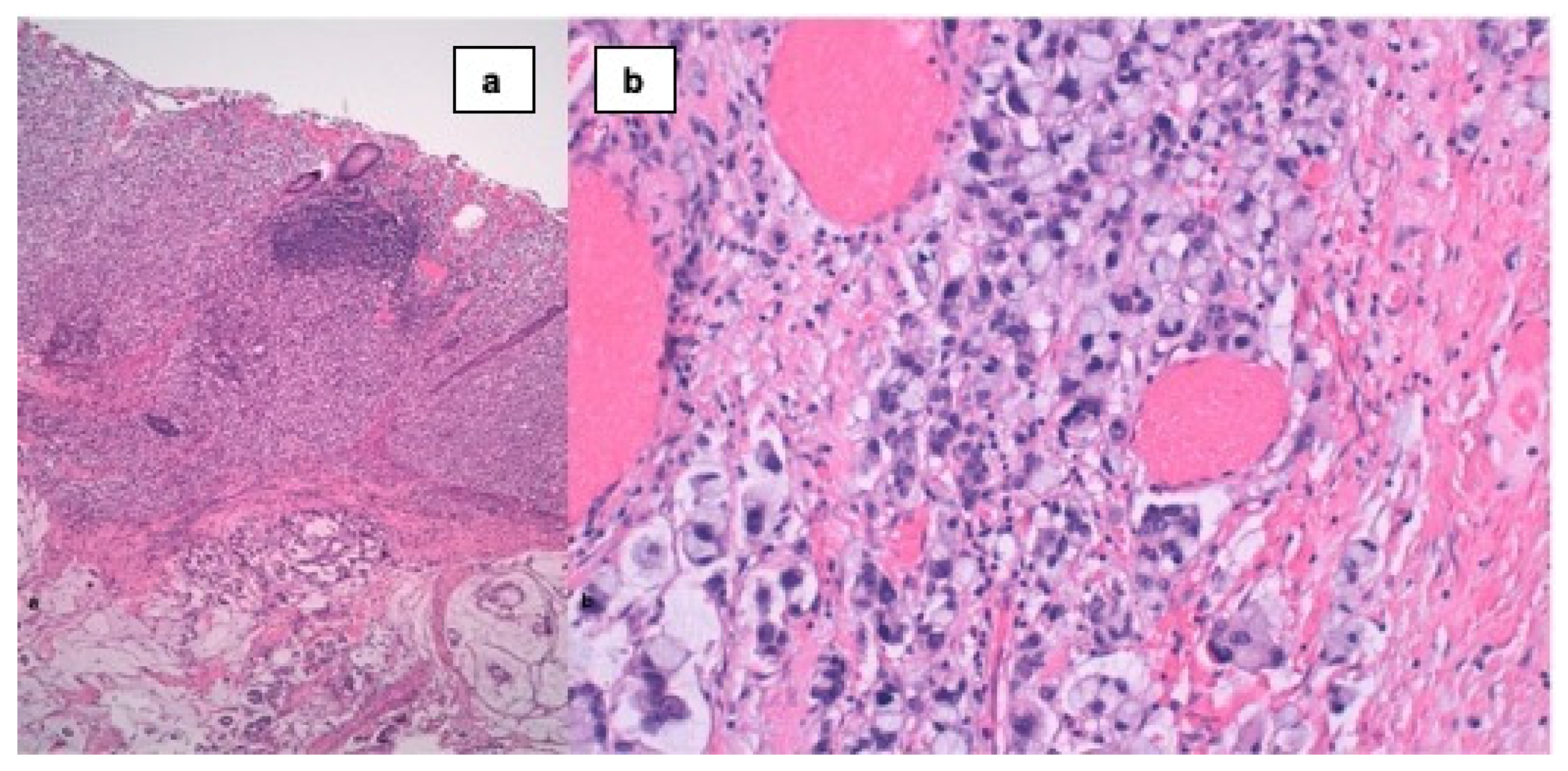 Incidence, Clinicopathological Features and Oncologic Outcome of ...