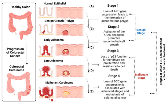 Focused Ultrasound as Targeted Therapy for Colorectal Cancer: A ...