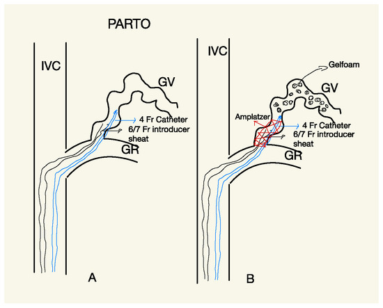Coil- and Plug-Assisted Transvenous Retrograde Obliteration (CARTO ...