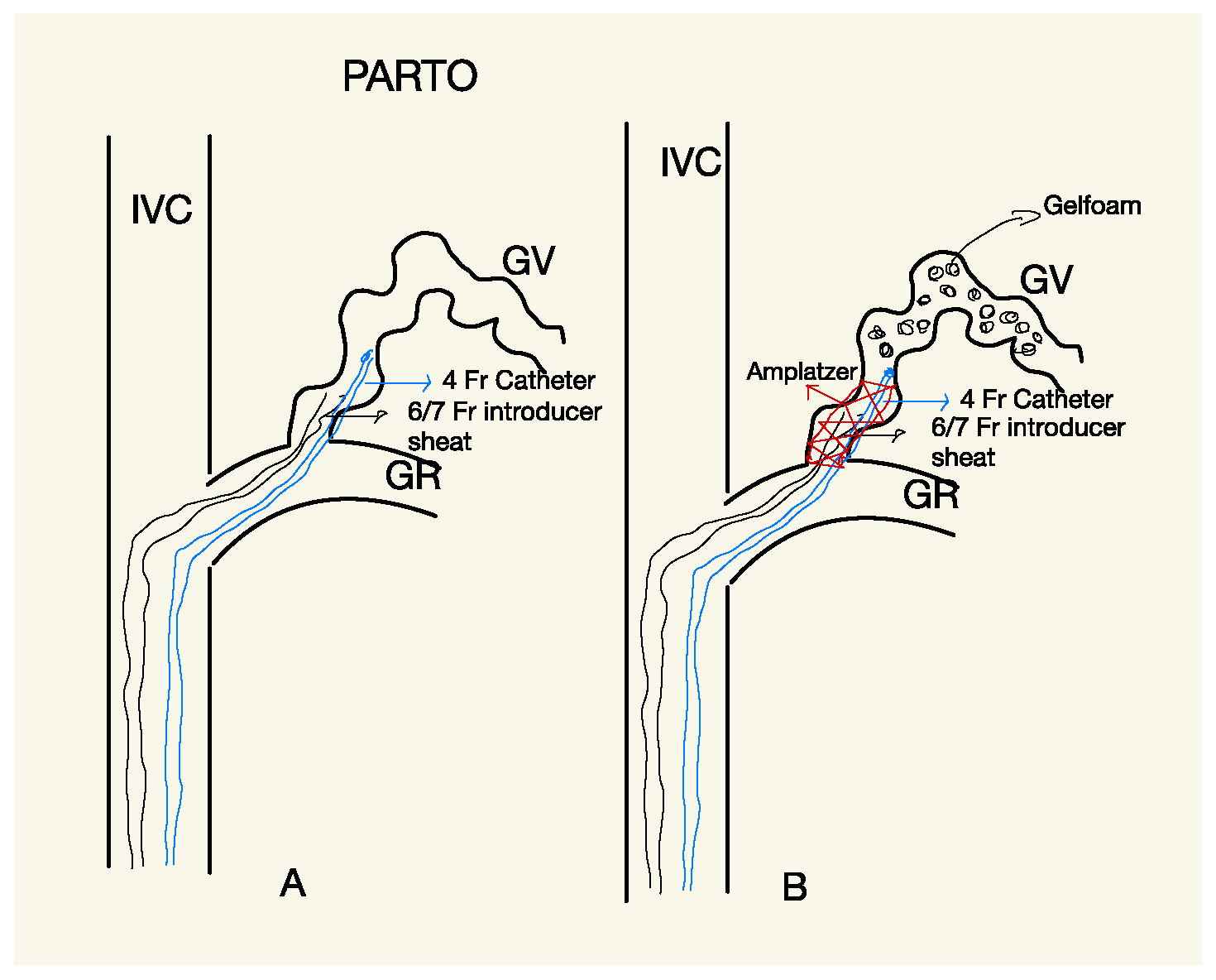 Coil- and Plug-Assisted Transvenous Retrograde Obliteration (CARTO ...