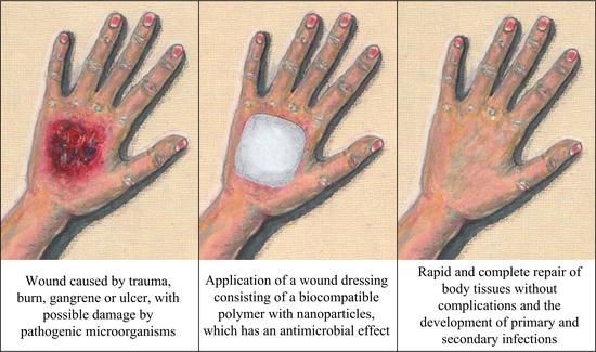 Gels | Free Full-Text | Nanoparticle-Containing Wound Dressing ...