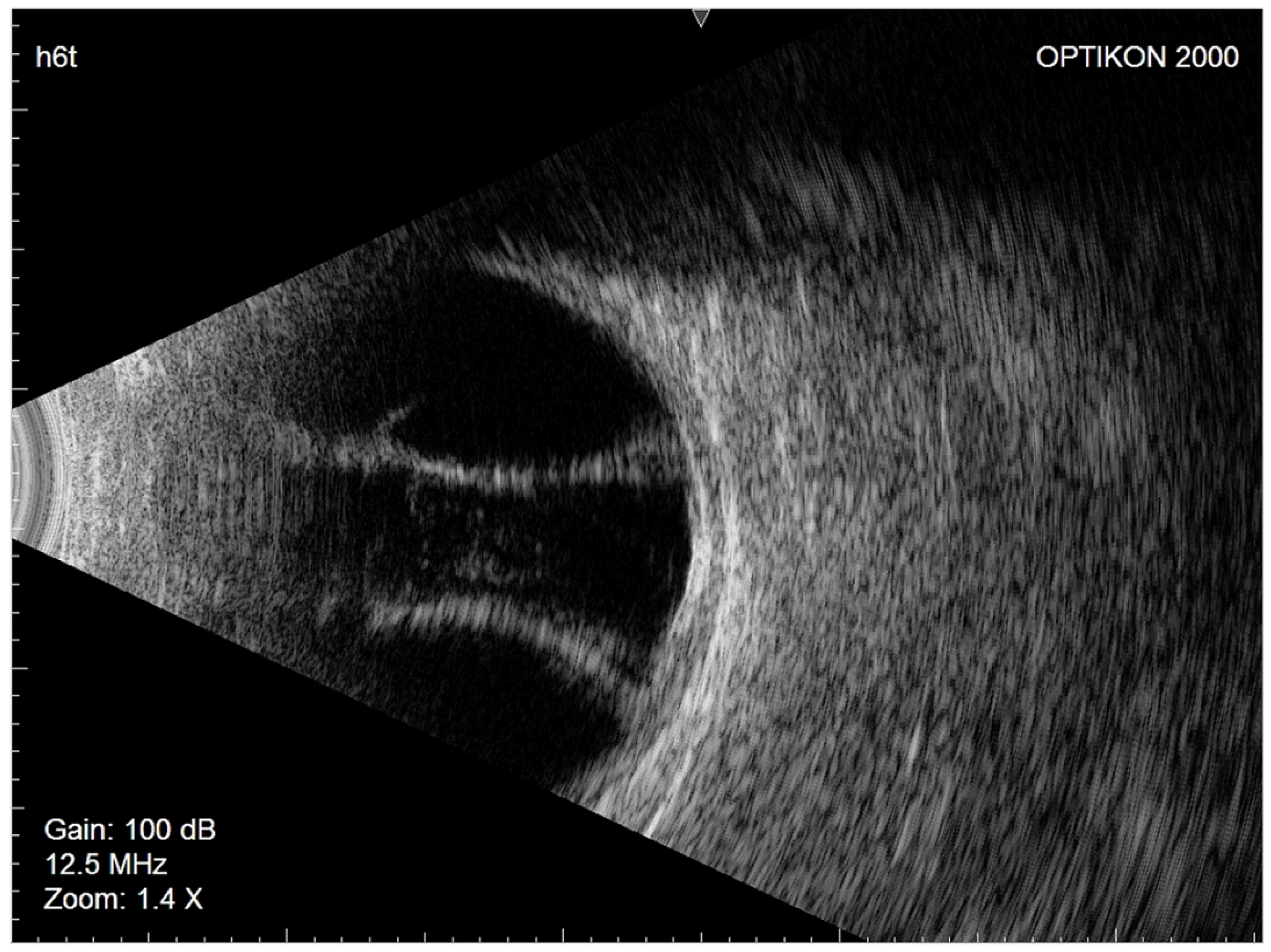 A Case of Bilateral Choroidal Effusion after XEN Gel Stent Implantation