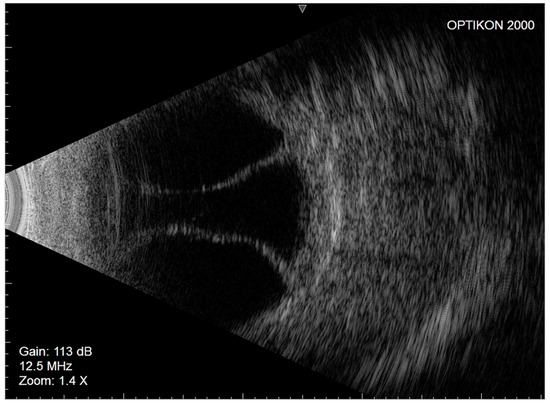 A Case of Bilateral Choroidal Effusion after XEN Gel Stent Implantation
