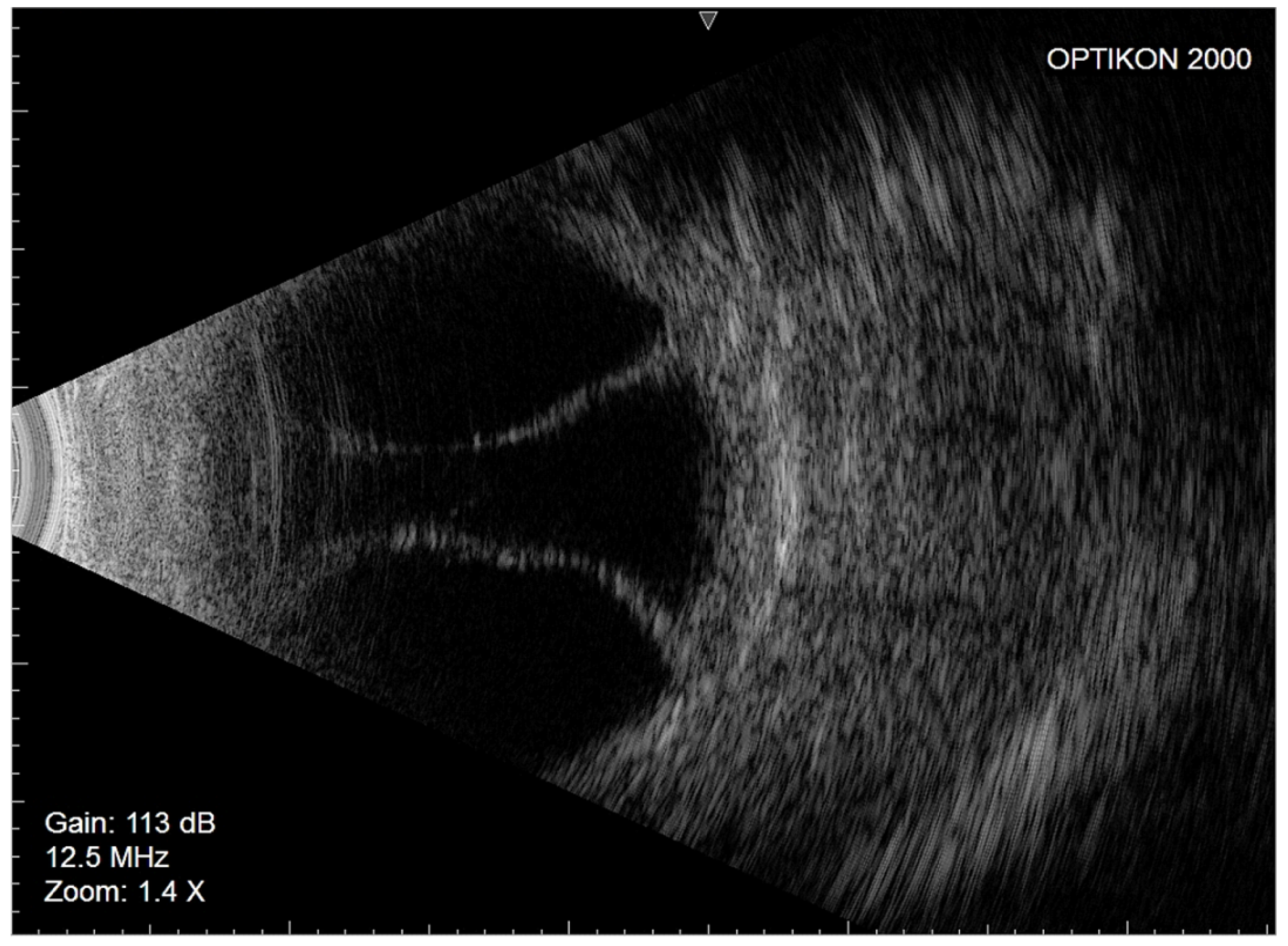 A Case of Bilateral Choroidal Effusion after XEN Gel Stent Implantation