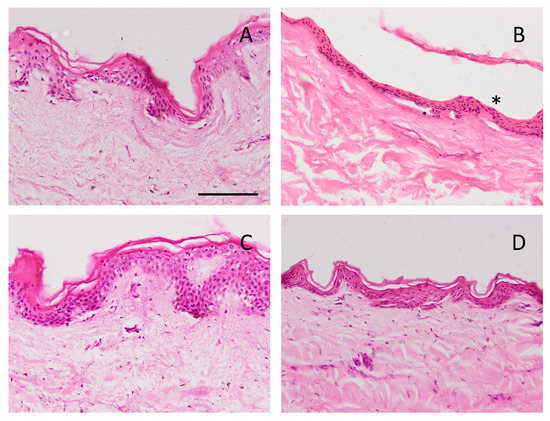 Gel Formulations with an Echinocandin for Cutaneous Candidiasis: The Influence of Azone and ...