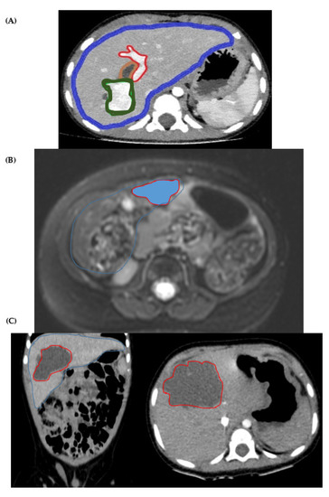 Patient-Specific 3D Printed Soft Models for Liver Surgical Planning and ...