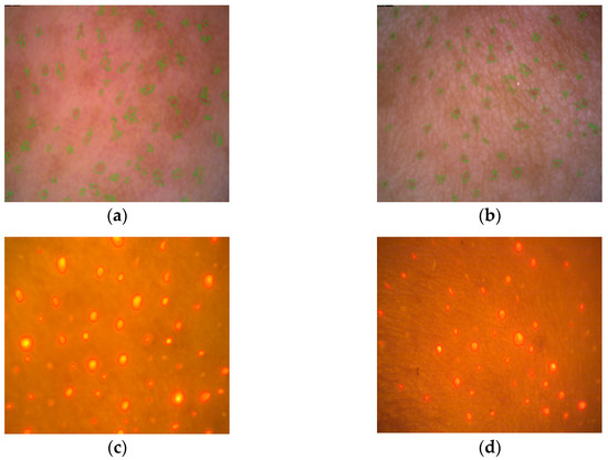 The Effect of Cosmetic Treatment and Gel Laser Therapy on the ...