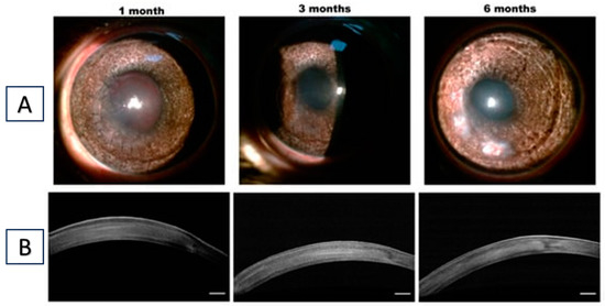 Collagen-Based Hydrogels for the Eye: A Comprehensive Review