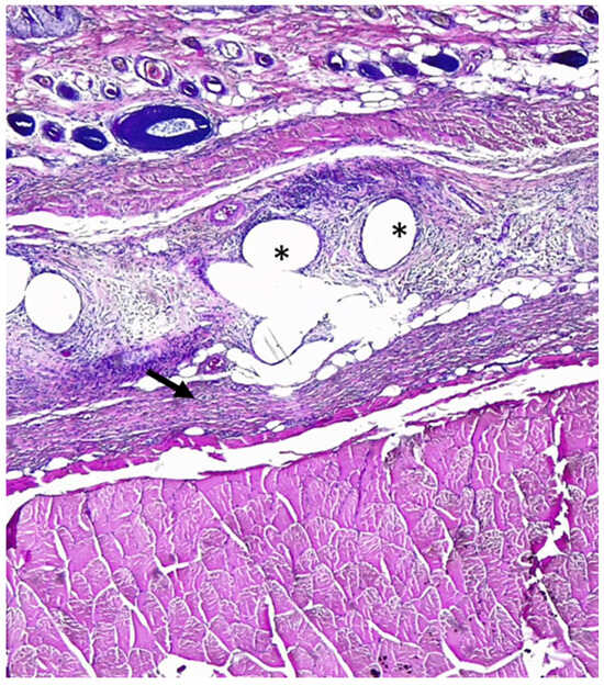 The Effects of Pectin–Honey Hydrogel in a Contaminated Chronic Hernia ...