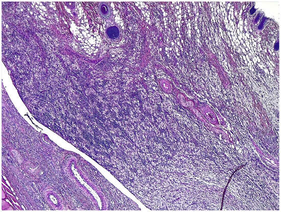 The Effects of Pectin–Honey Hydrogel in a Contaminated Chronic Hernia ...