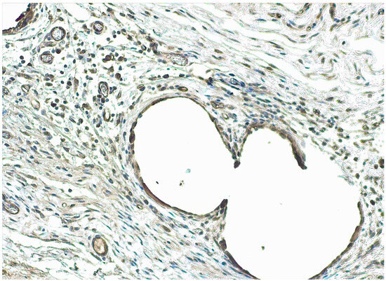 The Effects of Pectin–Honey Hydrogel in a Contaminated Chronic Hernia ...