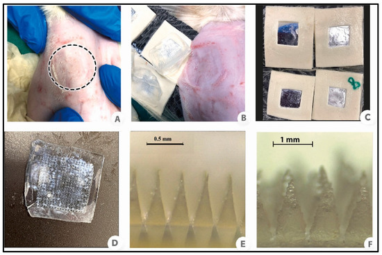 Hydrogel-Forming Microneedles in the Management of Dermal Disorders Through a Non-Invasive ...