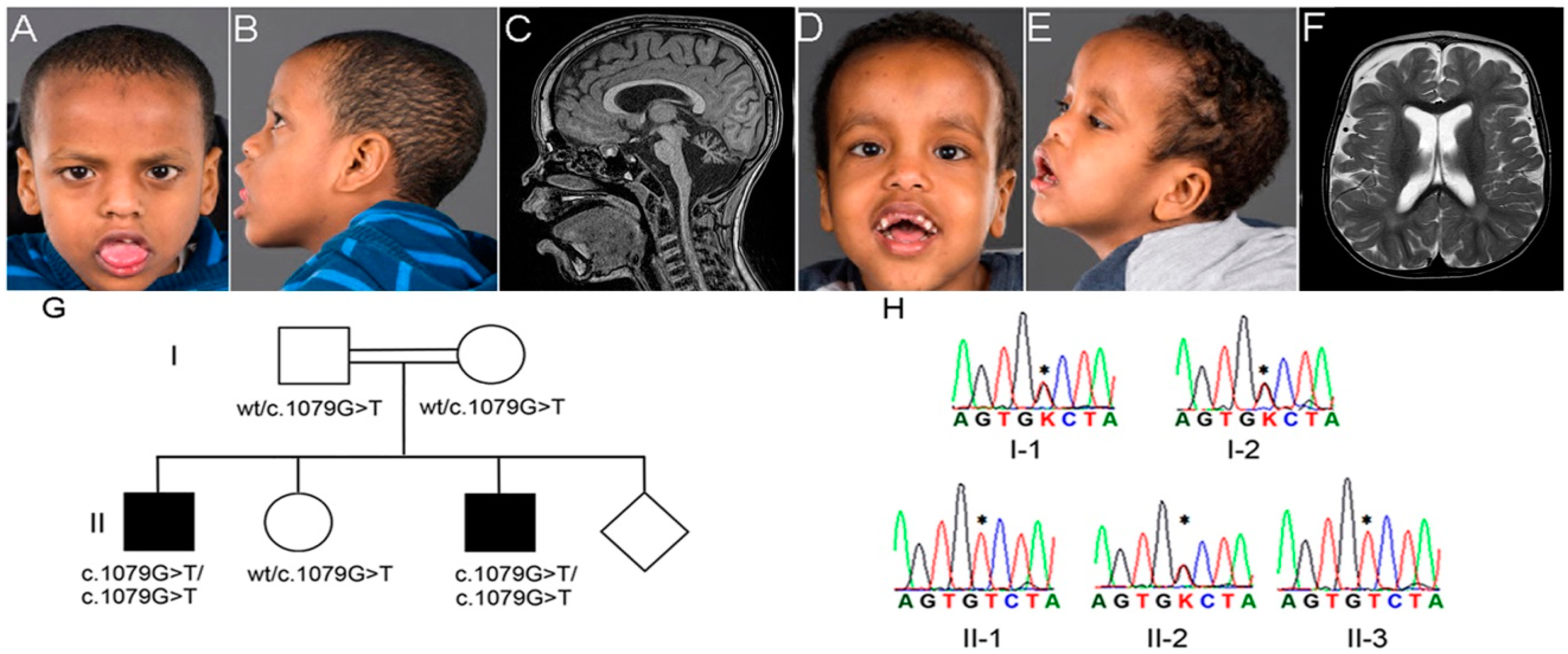 Genes | Free Full-Text | Novel PIGT Variant in Two Brothers: Expansion ...