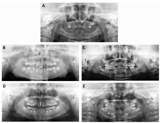 Genes | Free Full-Text | Novel EDA or EDAR Mutations Identified in ...
