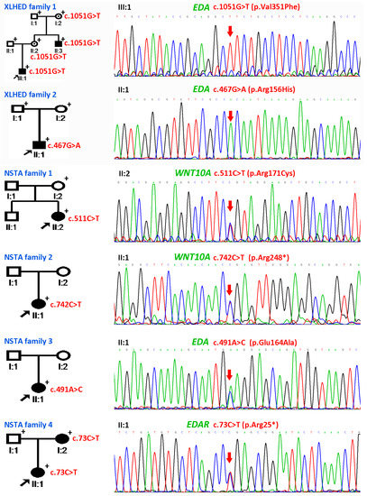 Genes | Free Full-Text | Novel EDA or EDAR Mutations Identified in ...