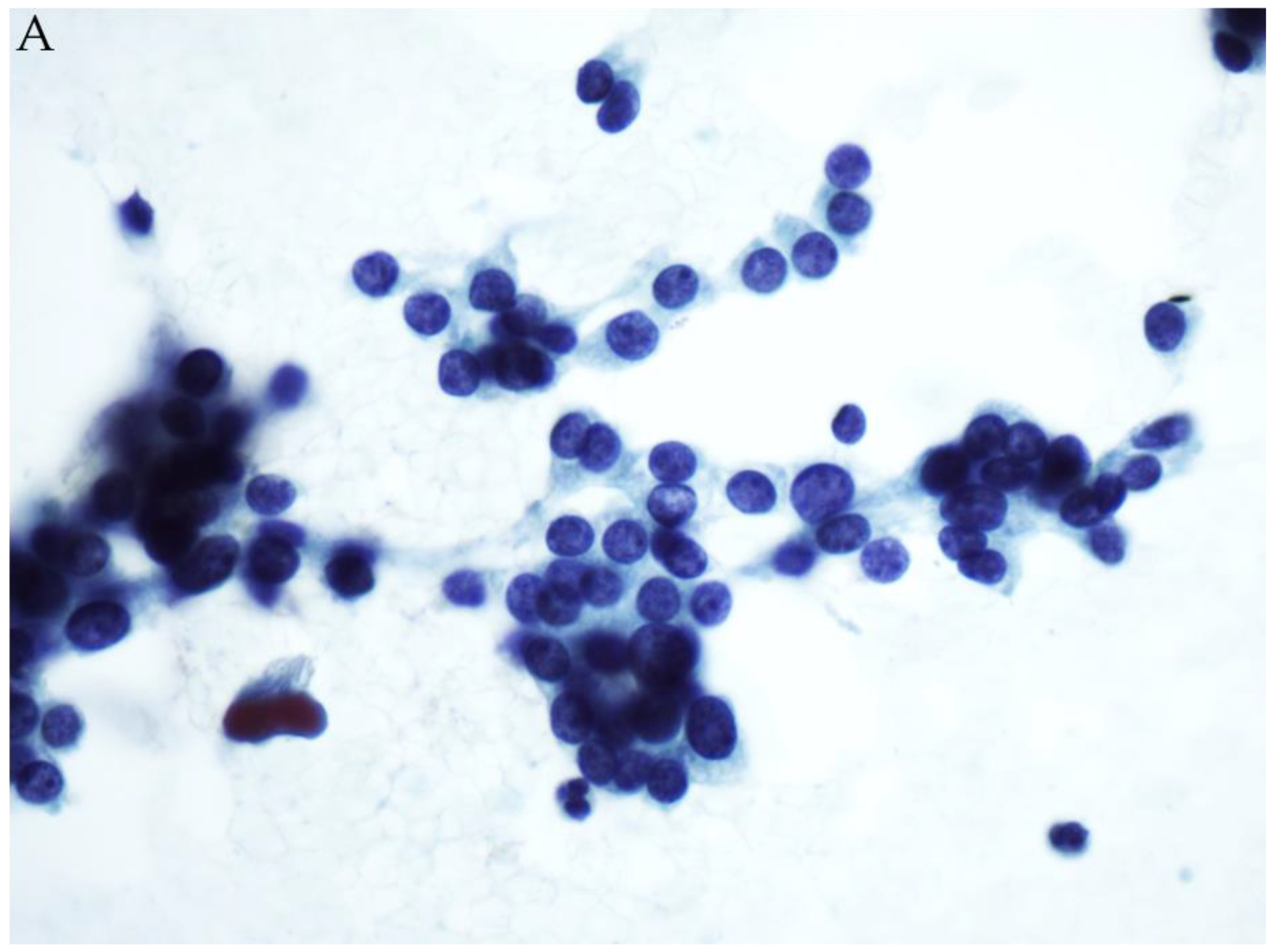 The Role of Molecular Testing for the Indeterminate Thyroid FNA