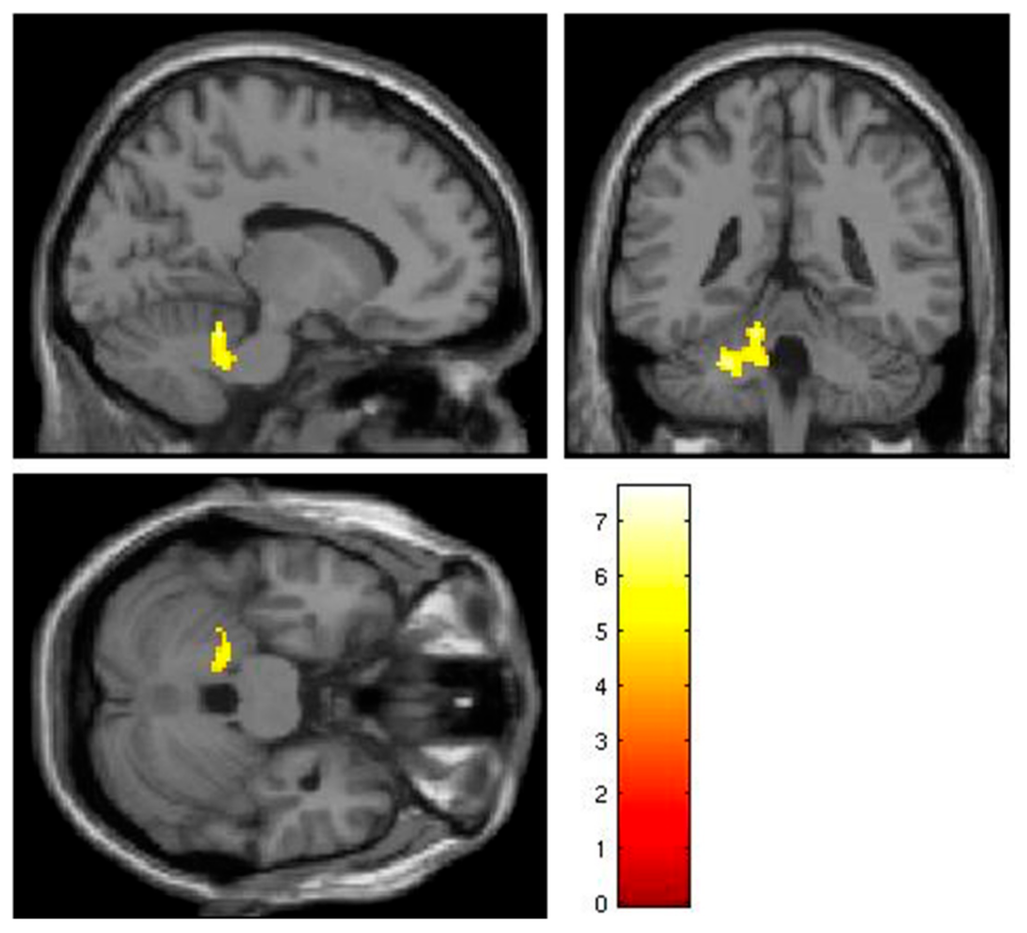 Genes | Free Full-Text | Autism in Fragile X Syndrome; A Functional MRI ...