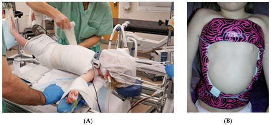 Clinical Observations and Treatment Approaches for Scoliosis in Prader ...