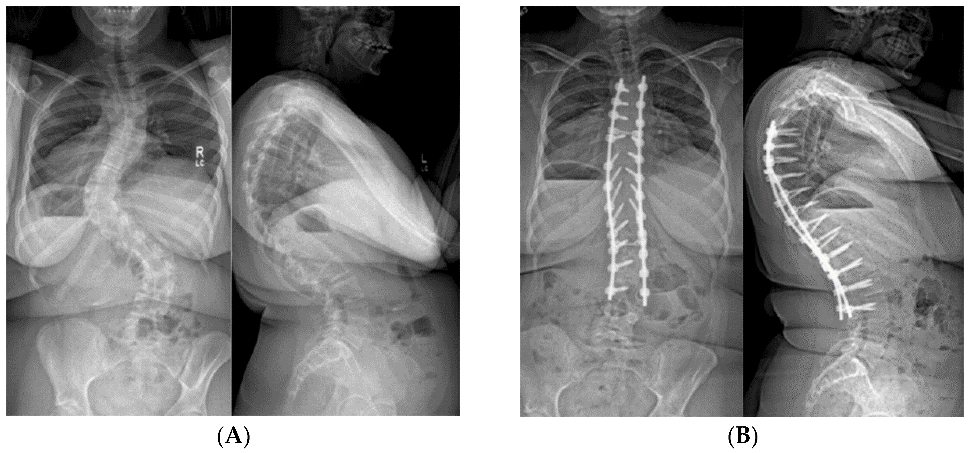 Clinical Observations and Treatment Approaches for Scoliosis in Prader ...