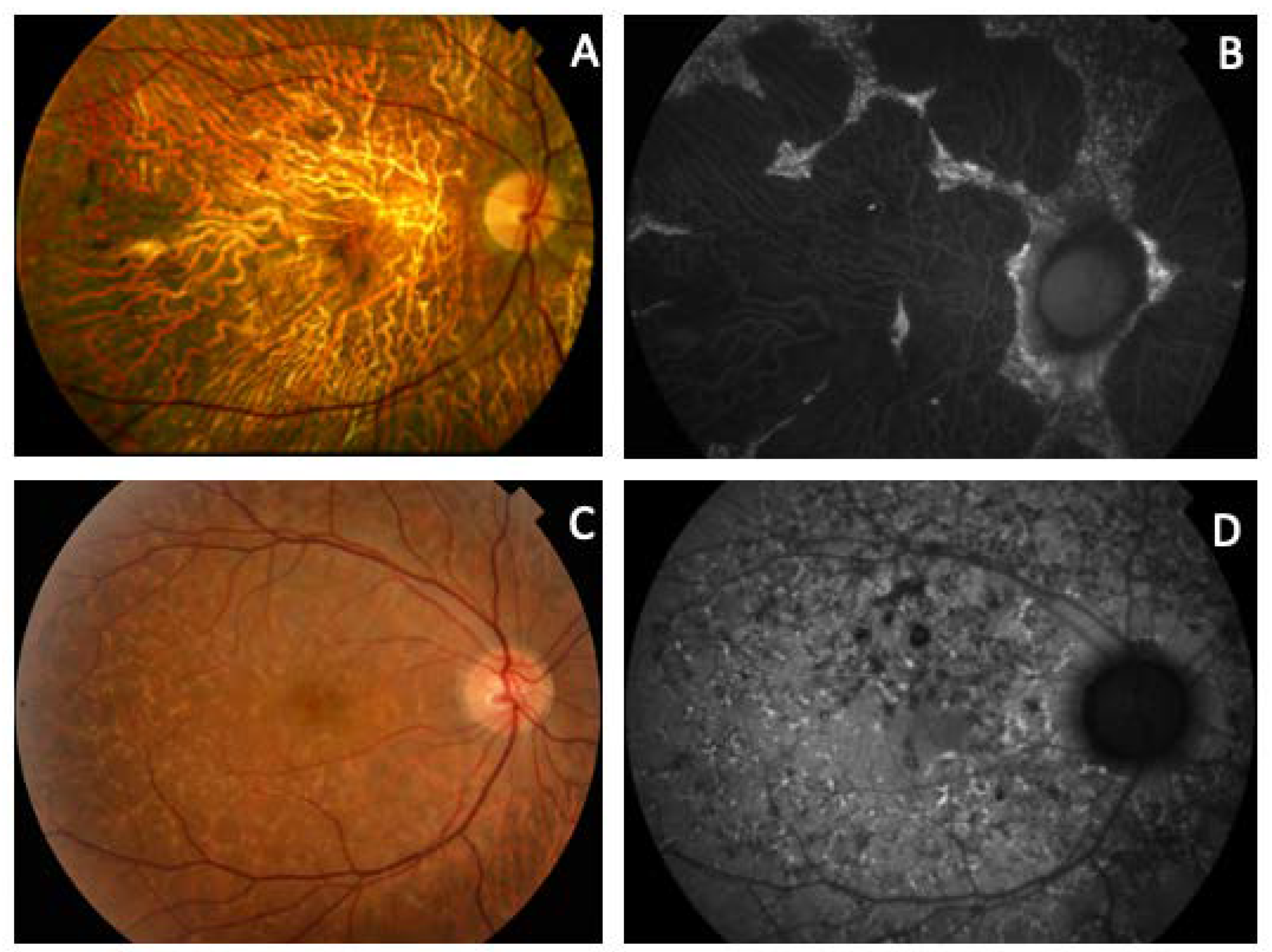 PRPH2-Related Retinal Diseases: Broadening the Clinical Spectrum and ...