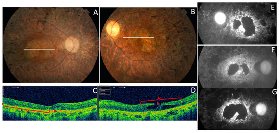PRPH2-Related Retinal Diseases: Broadening the Clinical Spectrum and ...