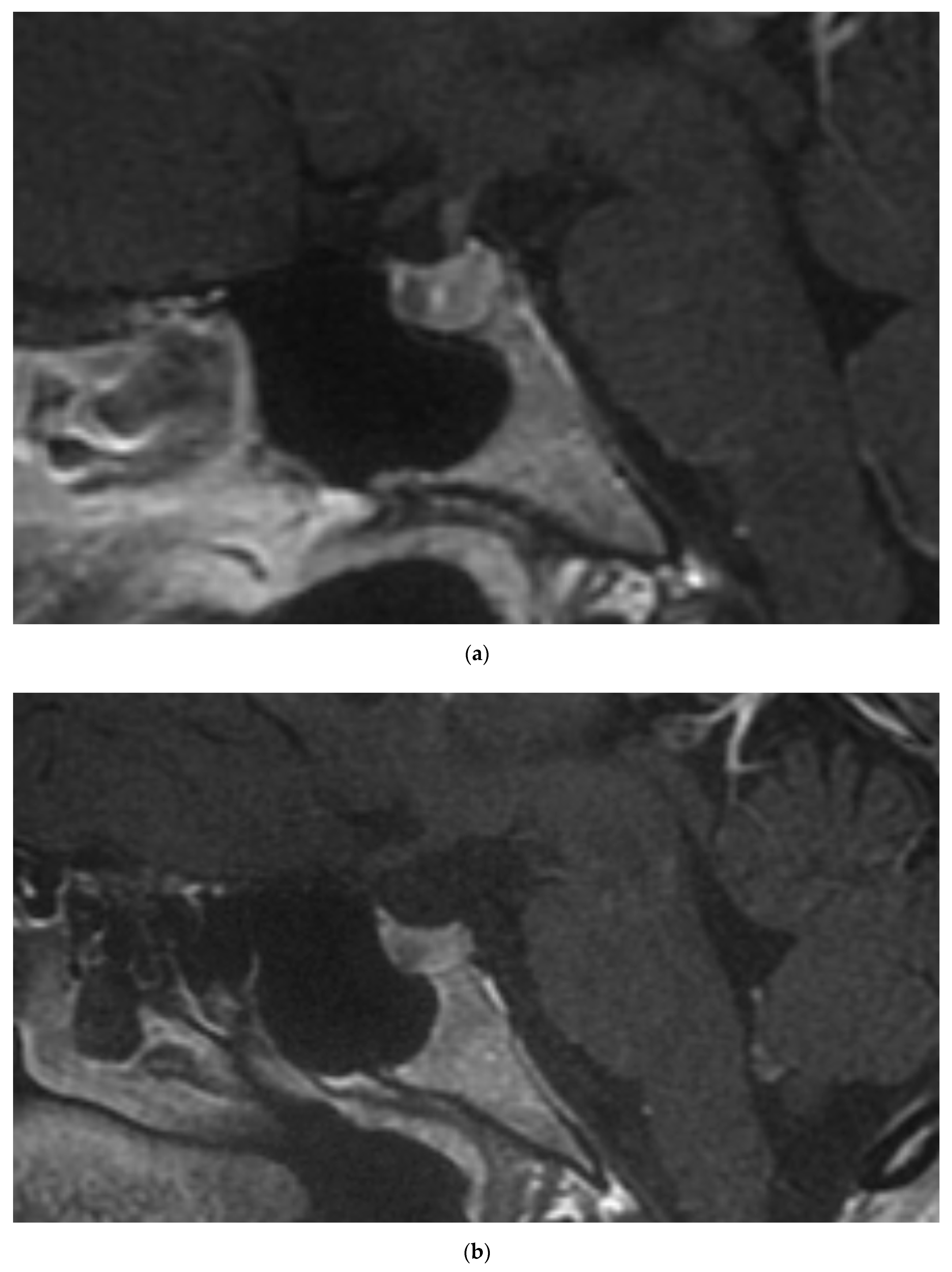 A Novel Germline c.1267T>A MEN1 Mutation in MEN1 Family—from Phenotype ...