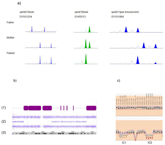 Prenatal Detection of Uniparental Disomies (UPD): Intended and ...