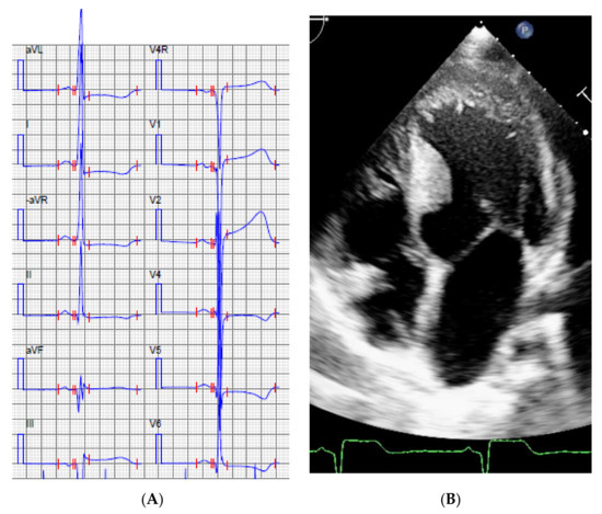Hereditary Hypertrophic Cardiomyopathy in Children and Young Adults—The ...