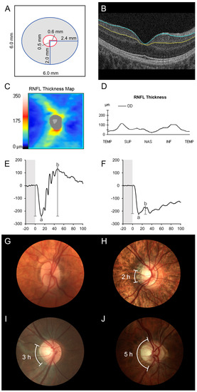 Optic Atrophy and Inner Retinal Thinning in CACNA1F-Related Congenital ...