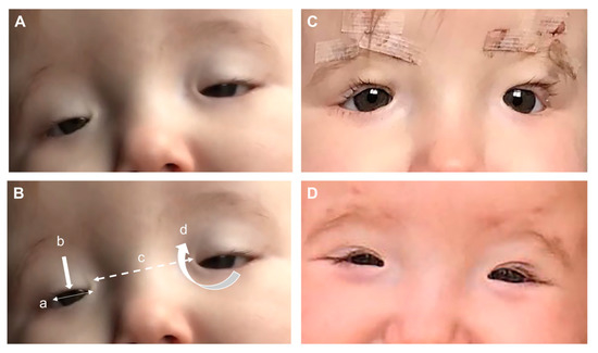 The Genetic and Clinical Features of FOXL2-Related Blepharophimosis ...