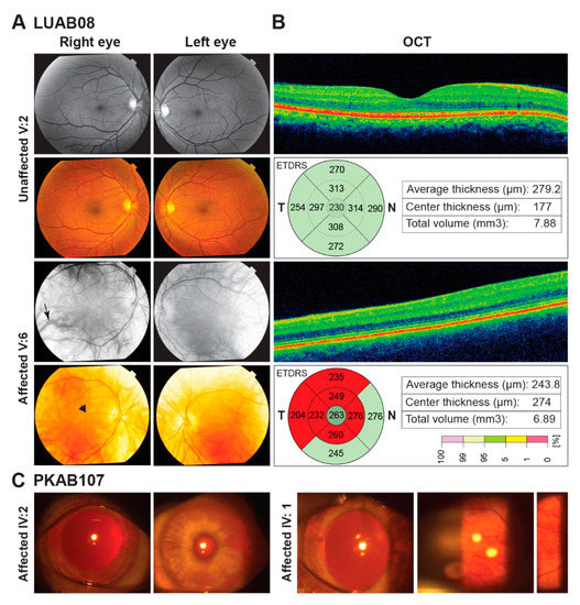 Genetic Causes of Oculocutaneous Albinism in Pakistani Population
