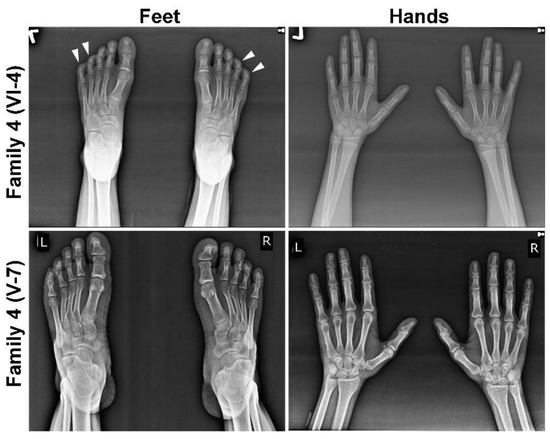 Genes | Free Full-Text | Modifier Genes in Microcephaly: A Report on ...