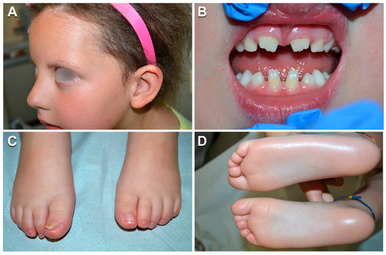 Ectodermal Dysplasia-Syndactyly Syndrome with Toe-Only Minimal ...