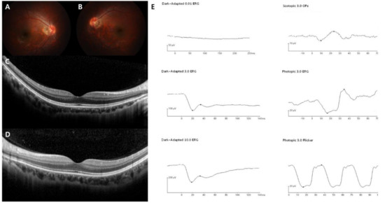 Genes | Free Full-Text | Clinical and Genetic Characteristics of Korean ...