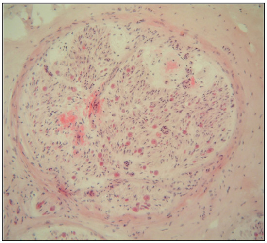 Ocular Involvement in Hereditary Amyloidosis
