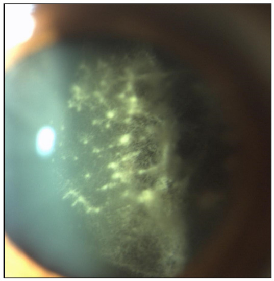 Christmas Tree Cataract Myotonic Dystrophy