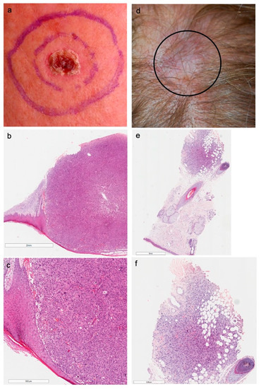 Clinicopathological and Genomic Profiles of Atypical Fibroxanthoma and ...
