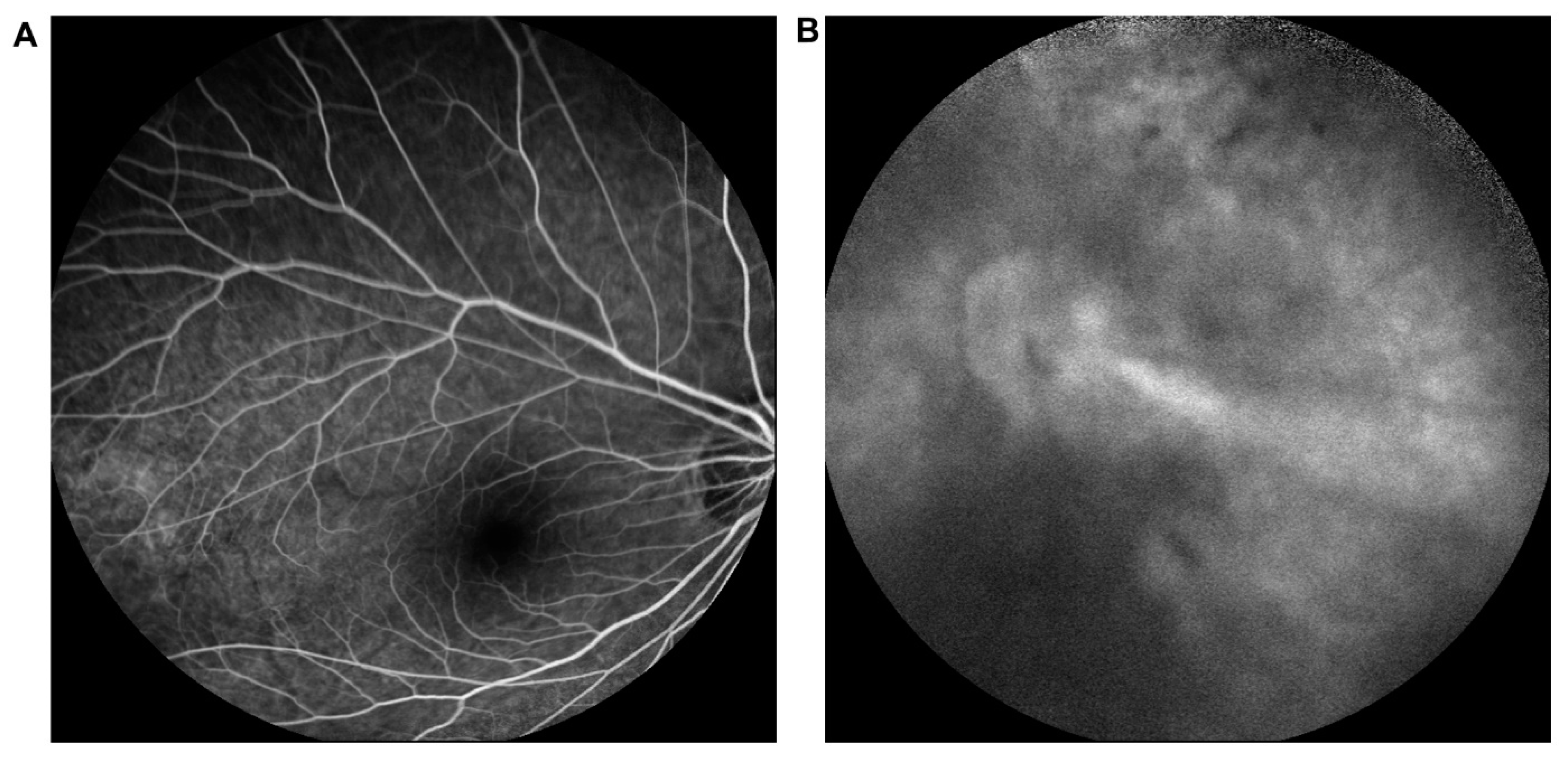 Genes | Free Full-Text | Whole-Gene Deletions of FZD4 Cause Familial ...