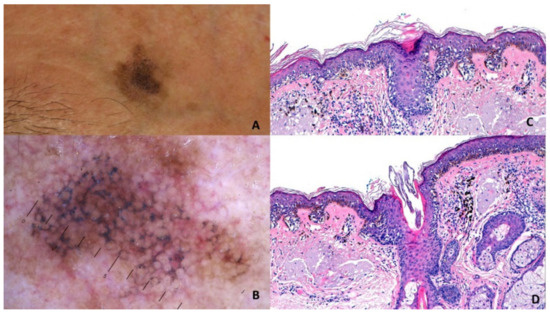 Dermoscopic Criteria, Histopathological Correlates and Genetic Findings ...