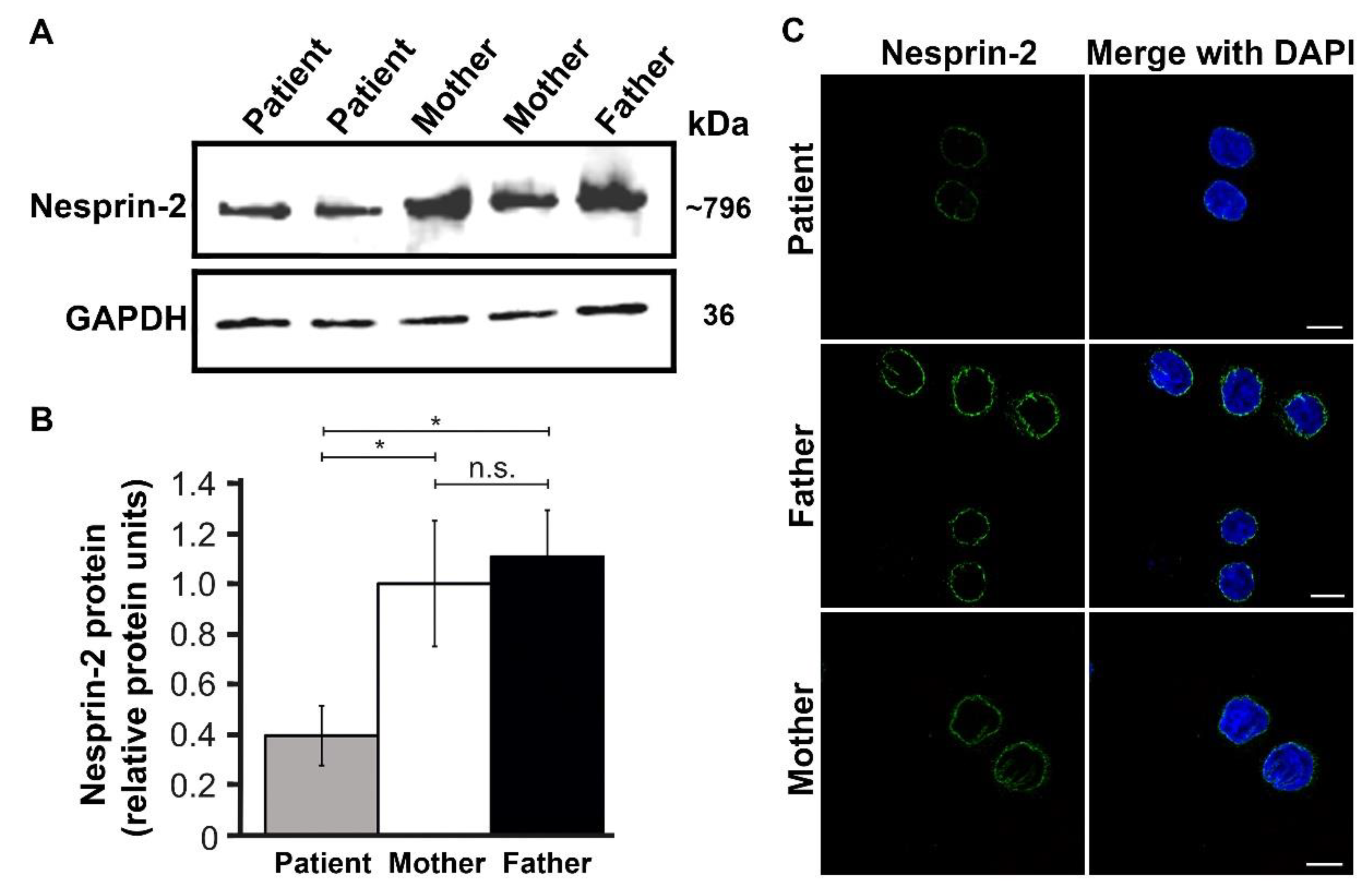 Biallelic SYNE2 Missense Mutations Leading to Nesprin-2 Giant Hypo ...