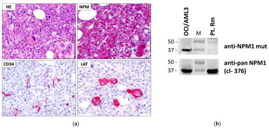 A Curious Novel Combination of Nucleophosmin (NPM1) Gene Mutations ...